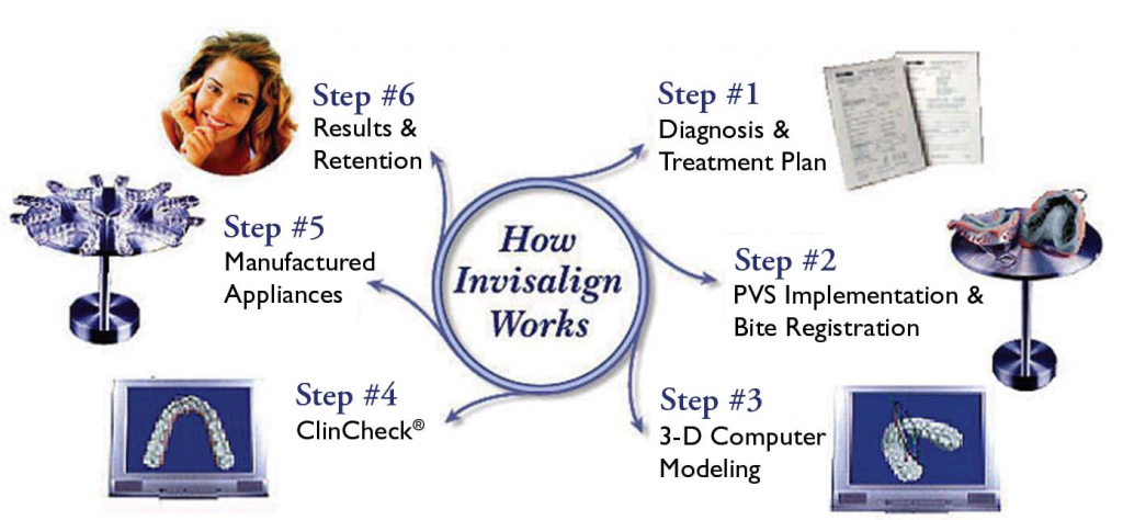 Invisalign® For Adults | Carmel Valley Orthodontist